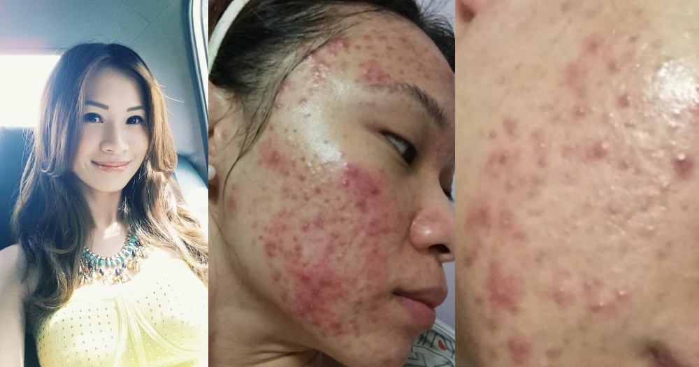 Plagued By Acne Problems Since Sec School Here s How This S porean