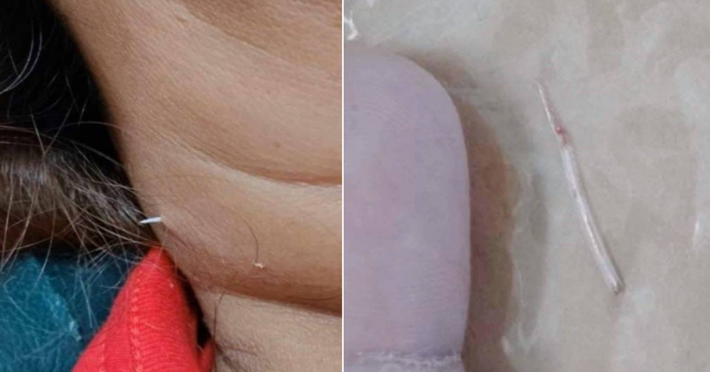 Fish bone stuck in Thai woman's throat pierces out of her neck, gets ...