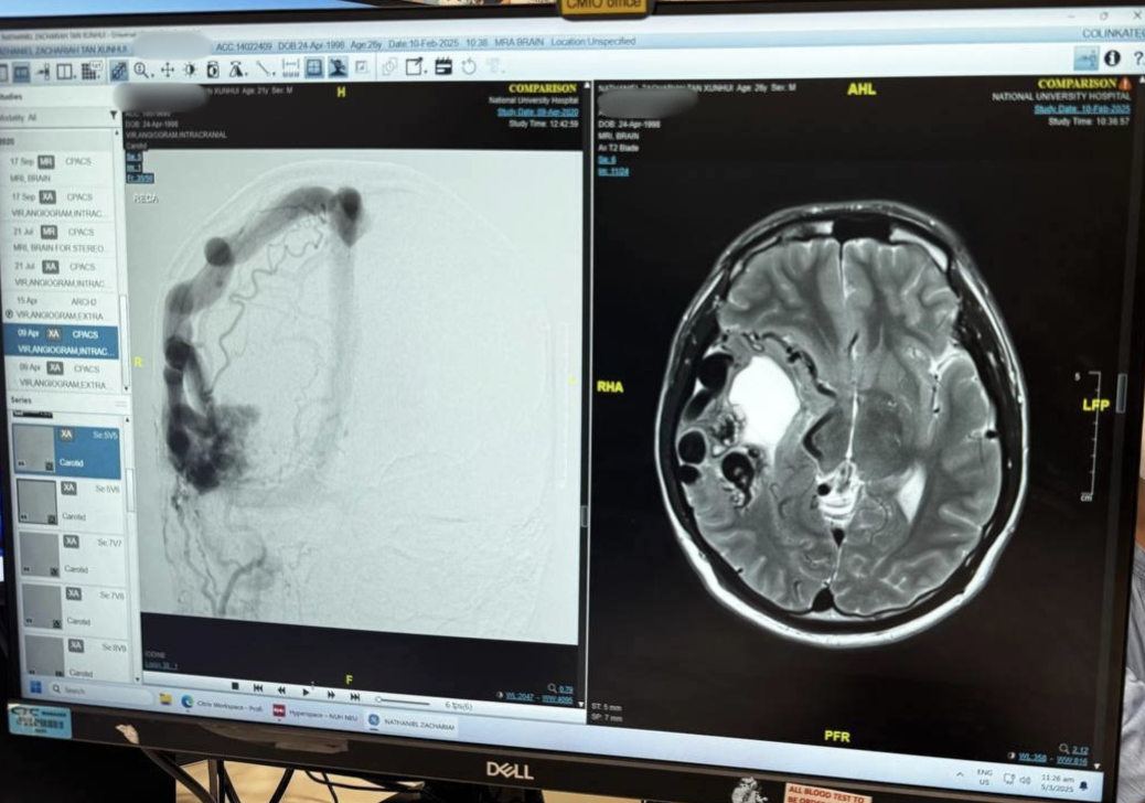 S'pore man, 27, passes away from rare brain condition, saves 4 lives ...